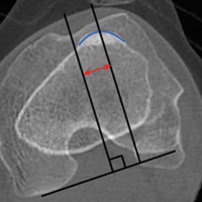 Measuring Malalignment on Imaging in the Treatment of Patellofemoral ...