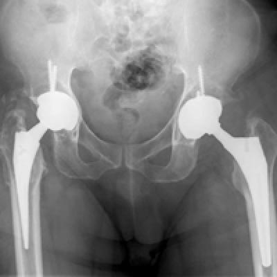 Acute Intraprosthetic Dissociation of a Dual-Mobility Hip in the United ...