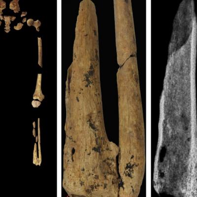 ‘Dr. Caveman’ had a leg up on amputation | MDedge Internal Medicine
