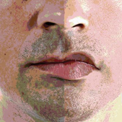 Case Studies in Toxicology: Angioedema Post-tPA: Hemorrhage Is Not the ...