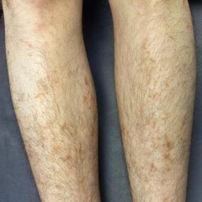 As Problem Spreads, Man Seeks Help | Clinician Reviews
