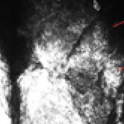 Reflectance Confocal Microscopy: An Effective Diagnostic Tool for ...