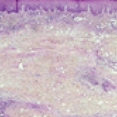 Necrobiosis Lipoidica Diabeticorum | MDedge Dermatology