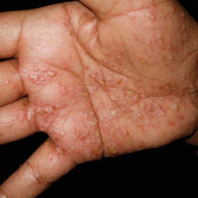 Palmoplantar Pustular Eruption Due to Dabigatran | MDedge Dermatology