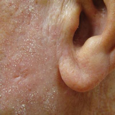 Lupus Erythematosus and Localized Scleroderma Coexistent at the Same ...