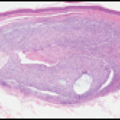 Growing Papule on the Right Shoulder of an Elderly Man | MDedge Dermatology