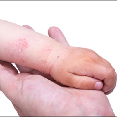 A Practical Overview of Pediatric Atopic Dermatitis, Part 2: Triggers ...