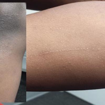 Lesions’ Pattern Helps Line Up Diagnosis | Clinician Reviews