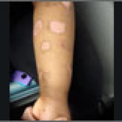 Well-defined macules on young girl’s forearms | MDedge Family Medicine