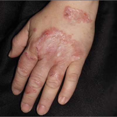 Plaques on dorsal hands & arms | MDedge Family Medicine