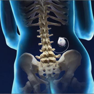 Intrathecal Analgesia: Time to Consider it for Your Patient ...