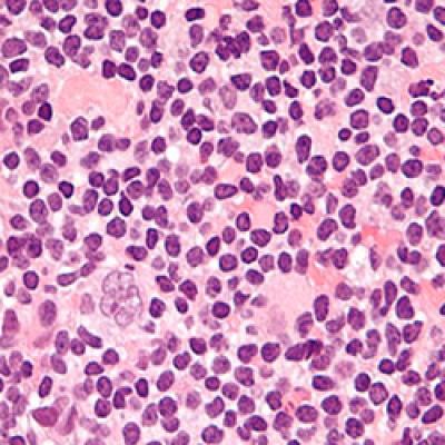 Treatment of choice for NLPHL? Involved-field RT alone | MDedge ...