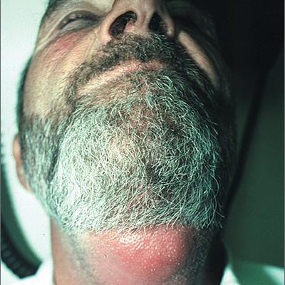 Swollen neck | MDedge Family Medicine