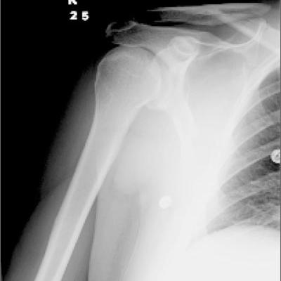 Clavicle pain, swelling, and bump | MDedge Family Medicine