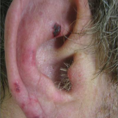 Painful ear nodules | MDedge Family Medicine
