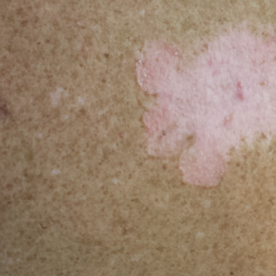 Excessive Sun Damage and a “Fungal Infection”? | Clinician Reviews
