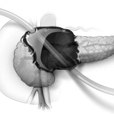 U-tube drainage adds option for necrotizing pancreatitis | MDedge Surgery