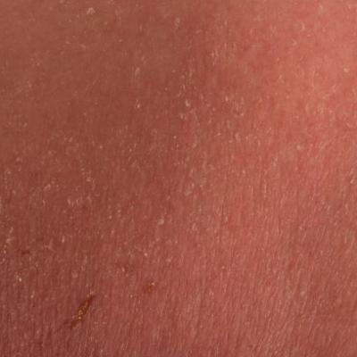 Sudden eruption of pruritus and pain | Atopic Dermatitis Challenge Center