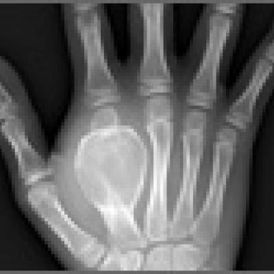 Aneurysmal Bone Cyst Involving the Metacarpal Bone in a Child | MDedge ...