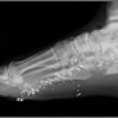 Atypical Presentation of Fat Embolism Syndrome After Gunshot Wound to ...