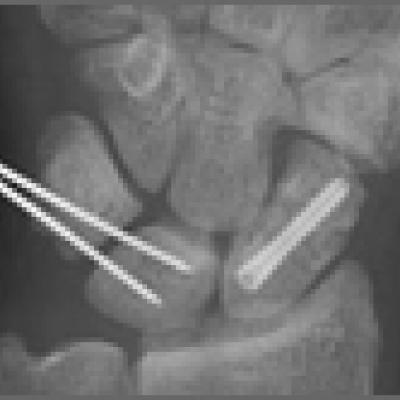 Perilunate Injuries | MDedge Surgery