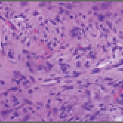 Osteofibrous Dysplasia–like Adamantinoma of the Tibia in a 15-Year-Old ...