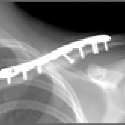 Is Skin Tenting Secondary to Displaced Clavicle Fracture More Than a ...