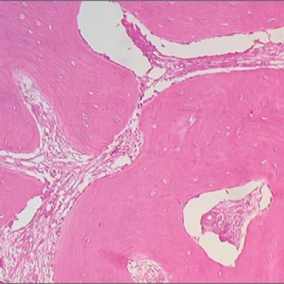 Giant Bone Island of the Tibia in a Child | MDedge Surgery