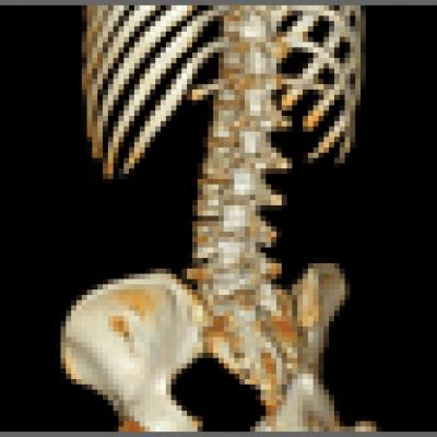 Pure Intrathoracic Scapular Dislocation | MDedge Surgery