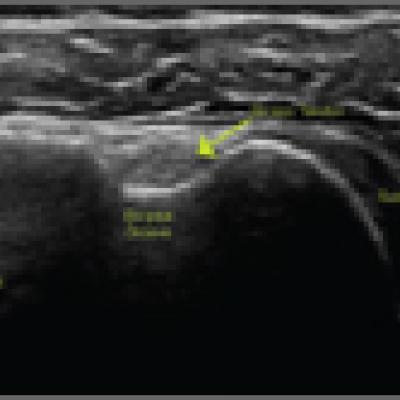 A Guide to Ultrasound of the Shoulder, Part 2: The Diagnostic ...