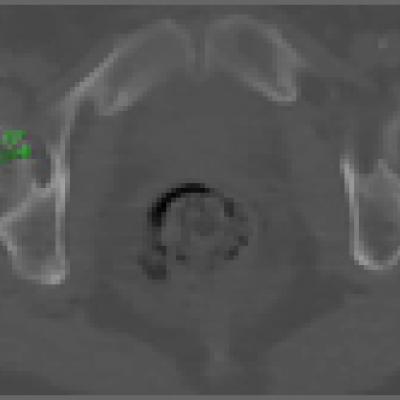 Linea Aspera as Rotational Landmark for Tumor Endoprostheses: A ...