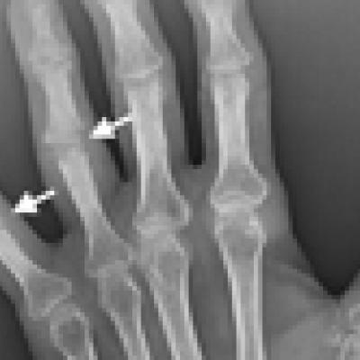 Silicone Arthroplasty After Ankylosis of Proximal Interphalangeal ...