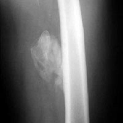 Thigh Injuries in American Football | MDedge Surgery