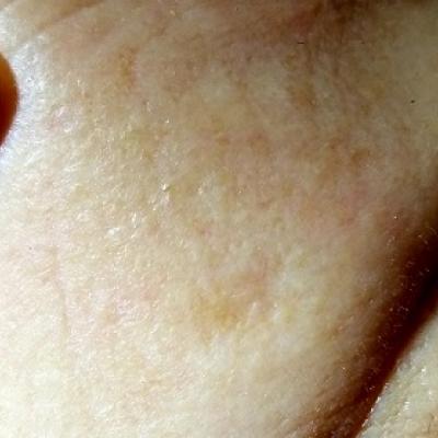 She Can’t Turn the Other Cheek on the Lesion | Clinician Reviews