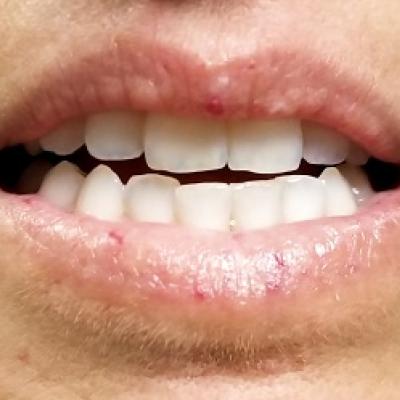 Scleroderma Lips Treatment | Lipstutorial.org