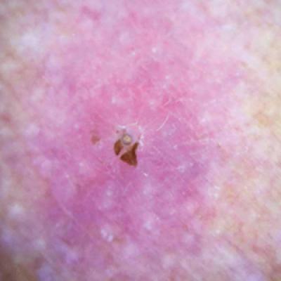 Punked By the Punctum: Domestically Acquired Cutaneous Myiasis | MDedge ...