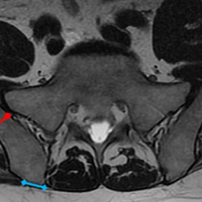 An MRI Analysis of the Pelvis to Determine the Ideal Method for ...