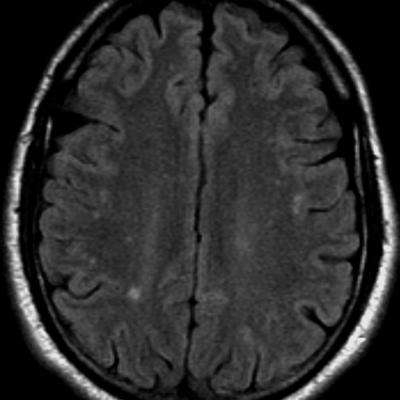 Throbbing headache and nausea | Migraine Challenge Center