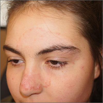 Scaly nose plaque | MDedge Family Medicine