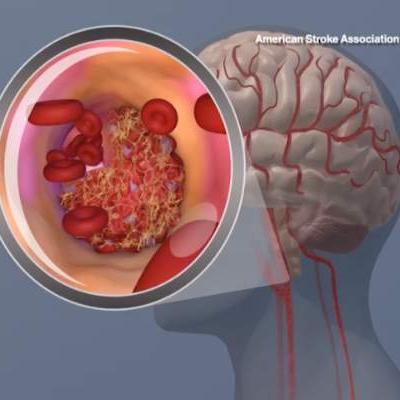 Updated acute stroke guideline boosts thrombectomy | MDedge Internal ...