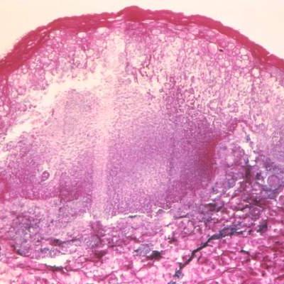 Postexposure smallpox vaccination not recommended for immunodeficient ...