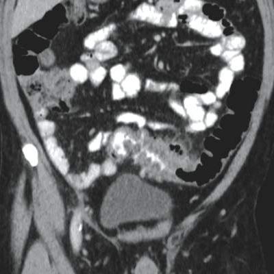 AGA updates guidelines for management of acute diverticulitis | GI and ...