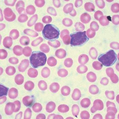 CLL patients achieve remission with CAR-modified T-cells | MDedge ...