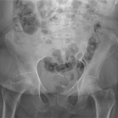 An Alarming Slip of the Hip | Clinician Reviews