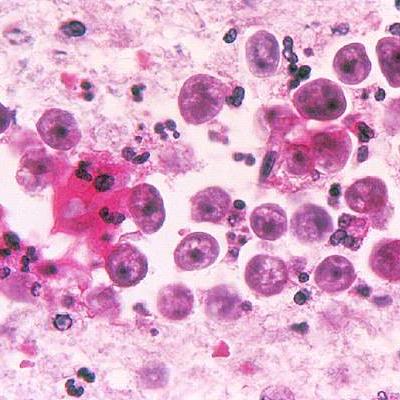 Early diagnosis of primary amebic meningoencephalitis key to treatment ...
