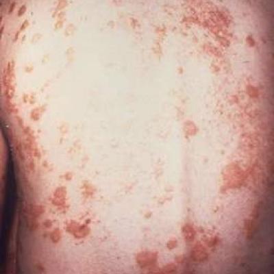 Ixekizumab for plaque psoriasis improves work productivity | MDedge ...
