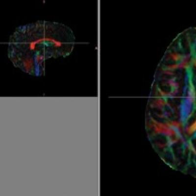 DTI detects long-term axonal injury in veterans with TBI | MDedge ...