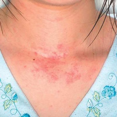 Consider combining therapies for atopic dermatitis | MDedge Internal ...