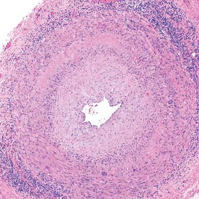 Vascular disease linked to sight loss in giant cell arteritis | MDedge ...