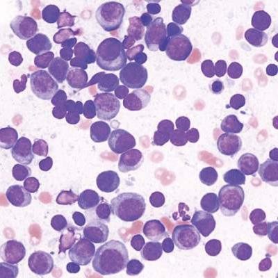 Smoldering multiple myeloma affects 1 in 7 patients | MDedge Hematology ...